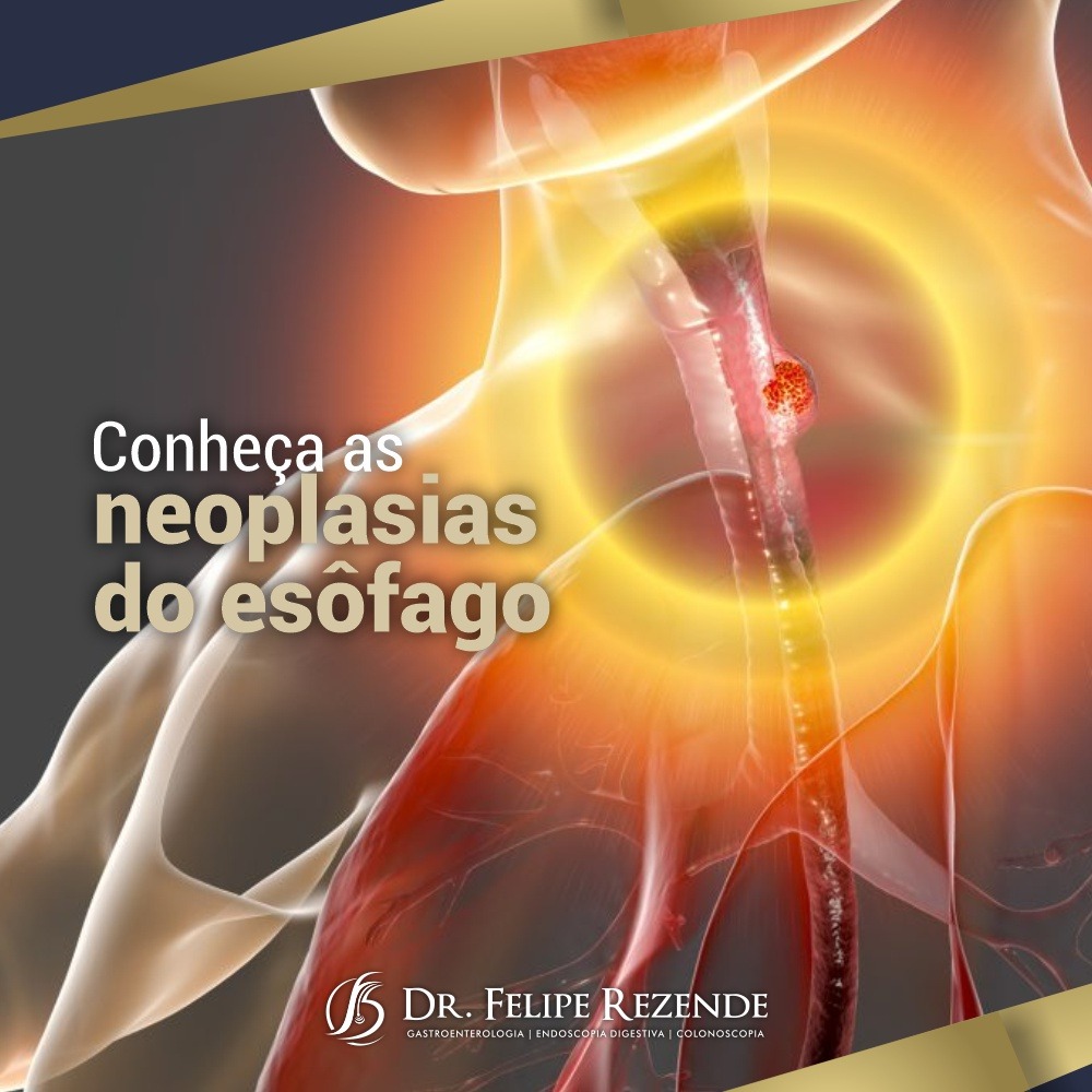 Dr. Felipe Rezende | Blog | Conheça as neoplasias do esôfago
