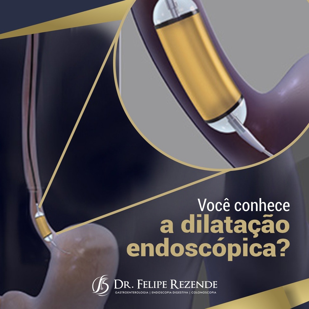 Dr. Felipe Rezende | Blog | Você conhece a dilatação endoscópica?