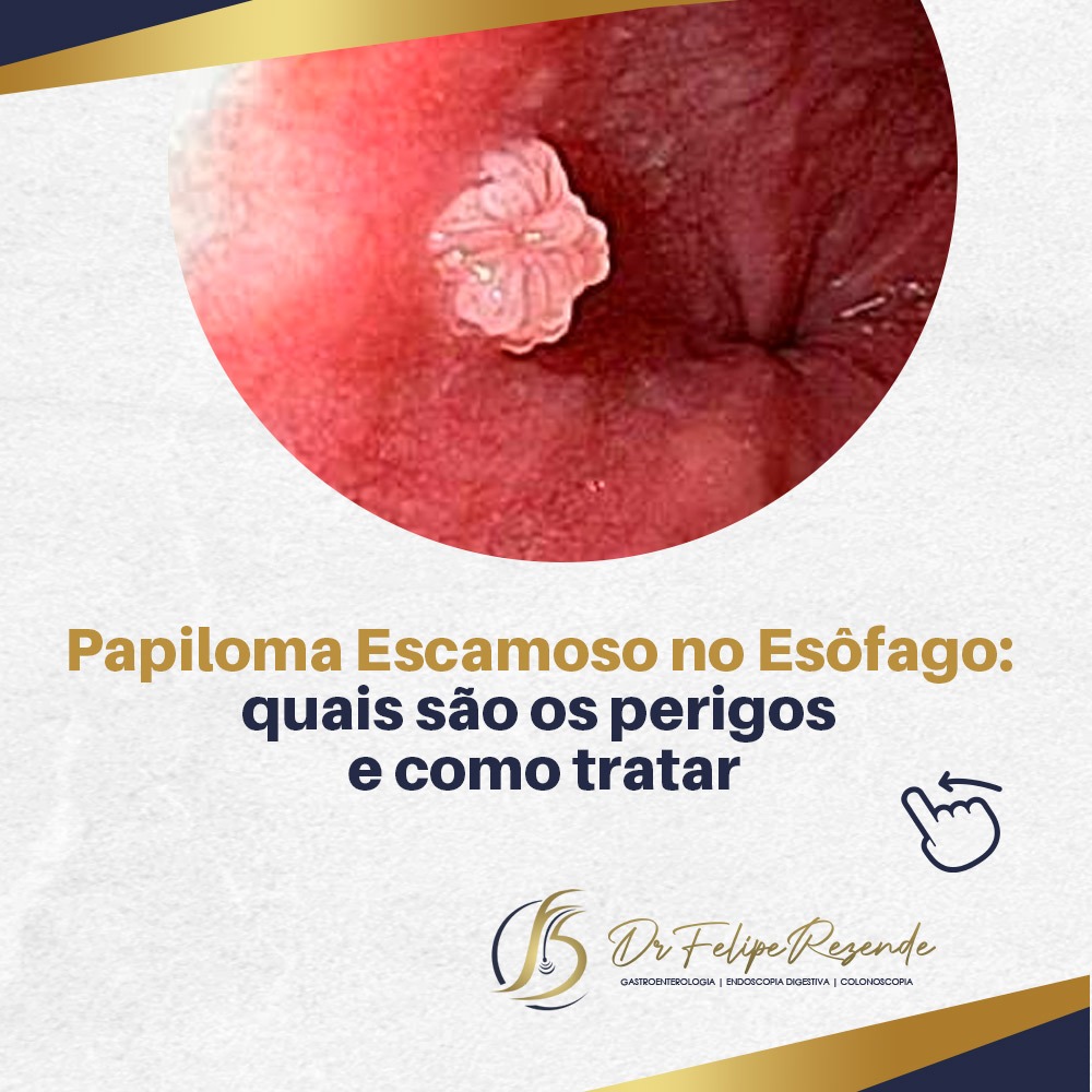 Polipo Escamoso SINTOMAS DE POLIPO NO INTESTINO QUE VOCE NAO SABIA